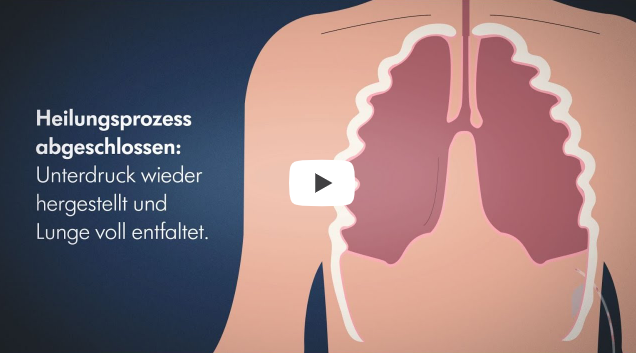 Wie funktioniert eine Thoraxdrainage? | Medela